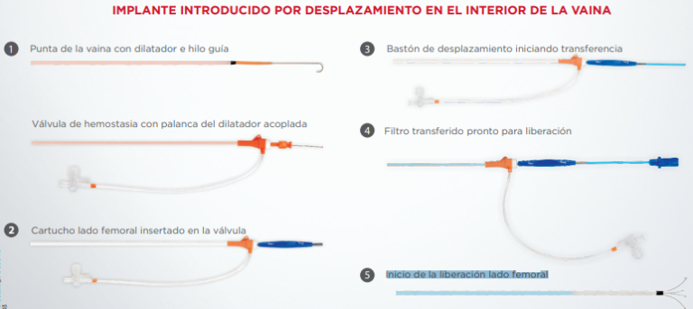Filtro para Vena Cava - Sumimeca